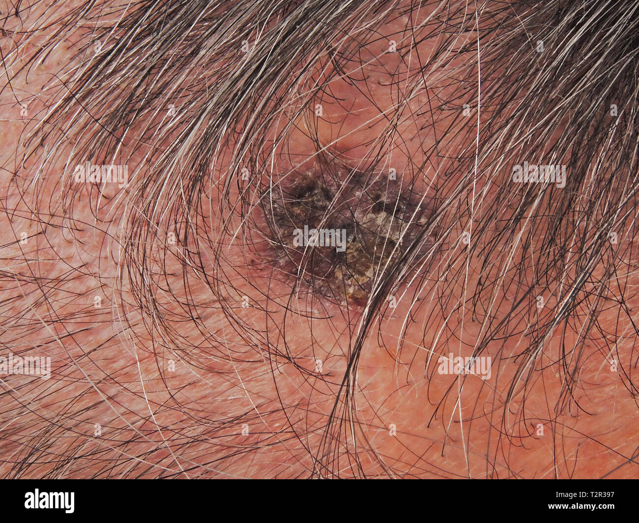 Carcinome baso cellulaire Banque de photographies et d’images à haute résolution - Page 2 - Alamy