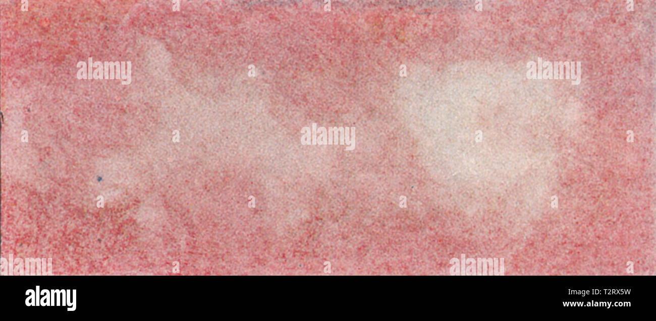 éruption de scarlatine Banque de photographies et d’images à haute ...