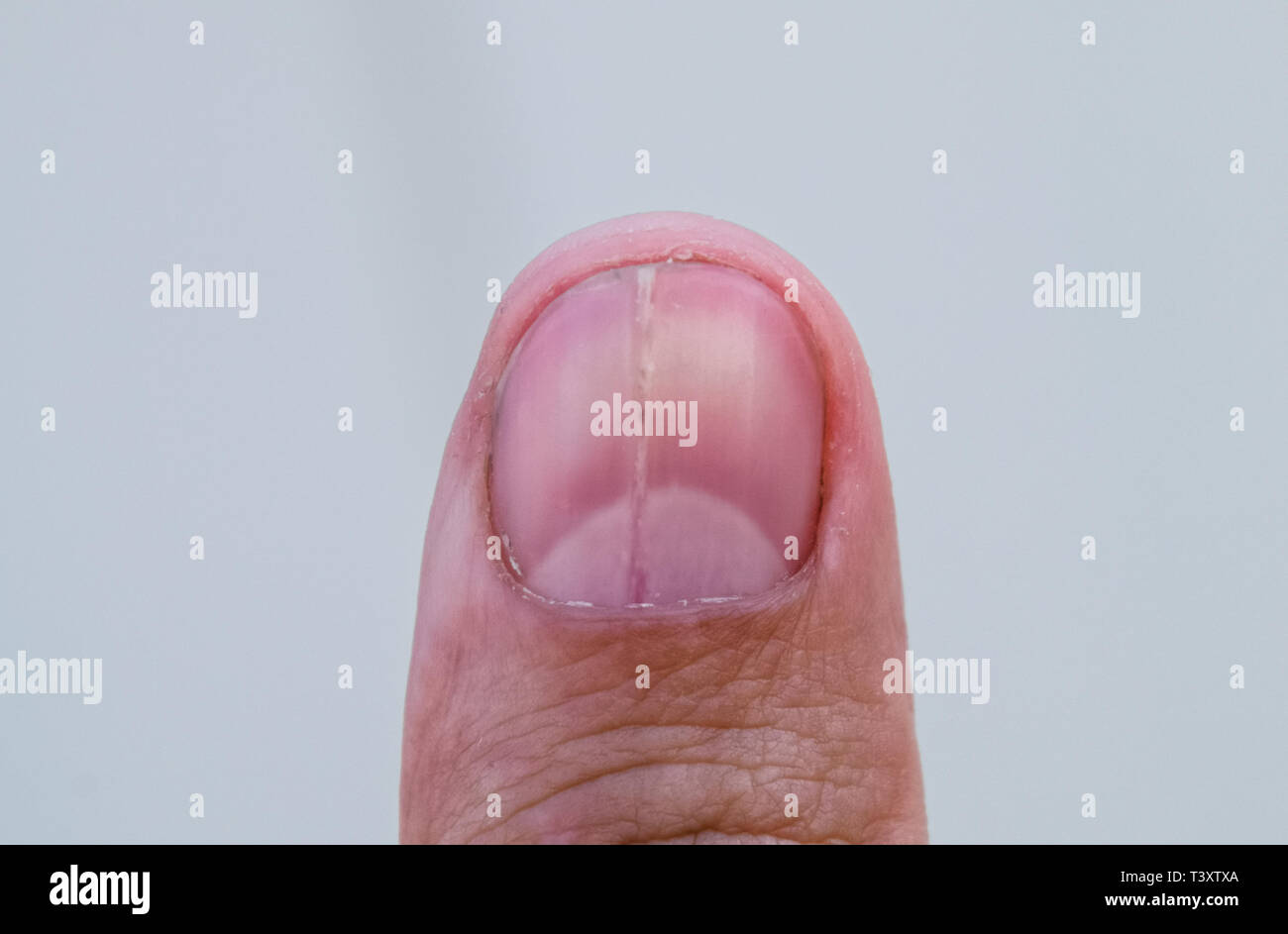 Ongle fourchue sur le pouce. Dilatation de l'ongle, la pathologie ...