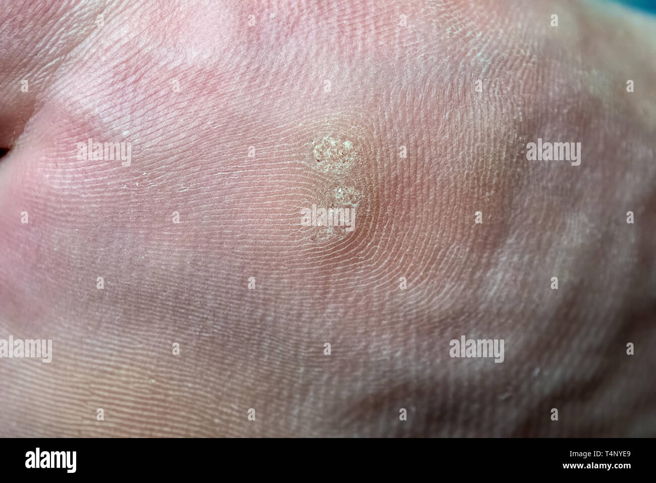 Wart human Banque de photographies et d’images à haute résolution - Alamy