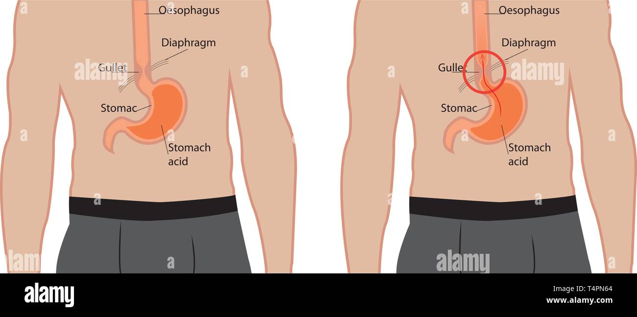 La maladie Gastroesophageal de reflux. Gerd estomac dans un corps ...
