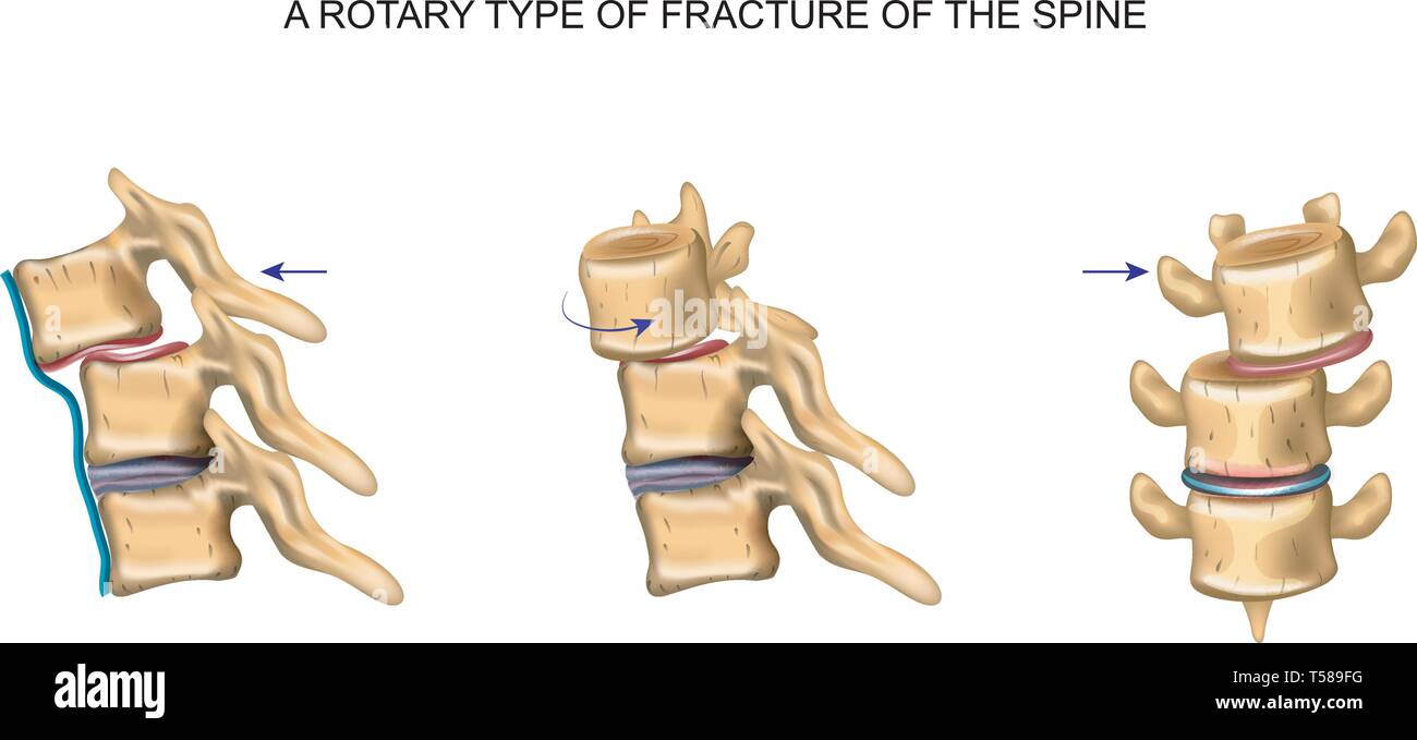 Vertebral fracture Banque de photographies et d’images à haute ...