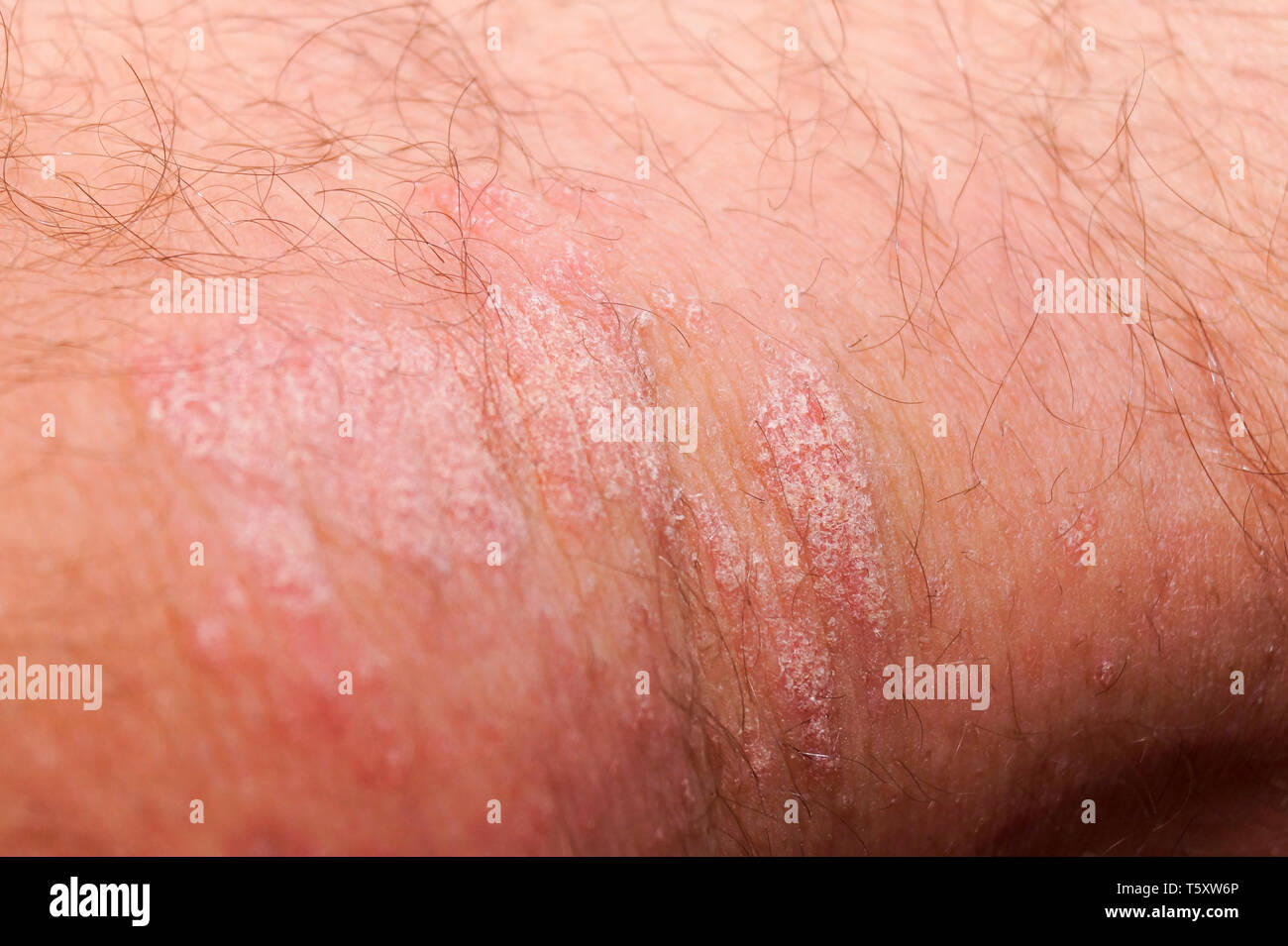 Pustular psoriasis Banque de photographies et d’images à haute ...