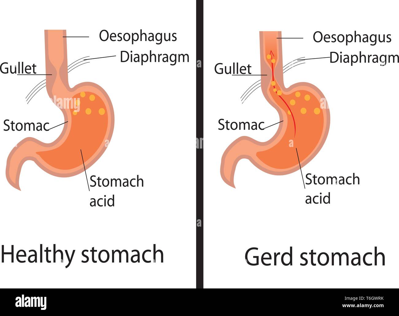 La maladie Gastroesophageal de reflux acide. Gerd et estomac sain ...