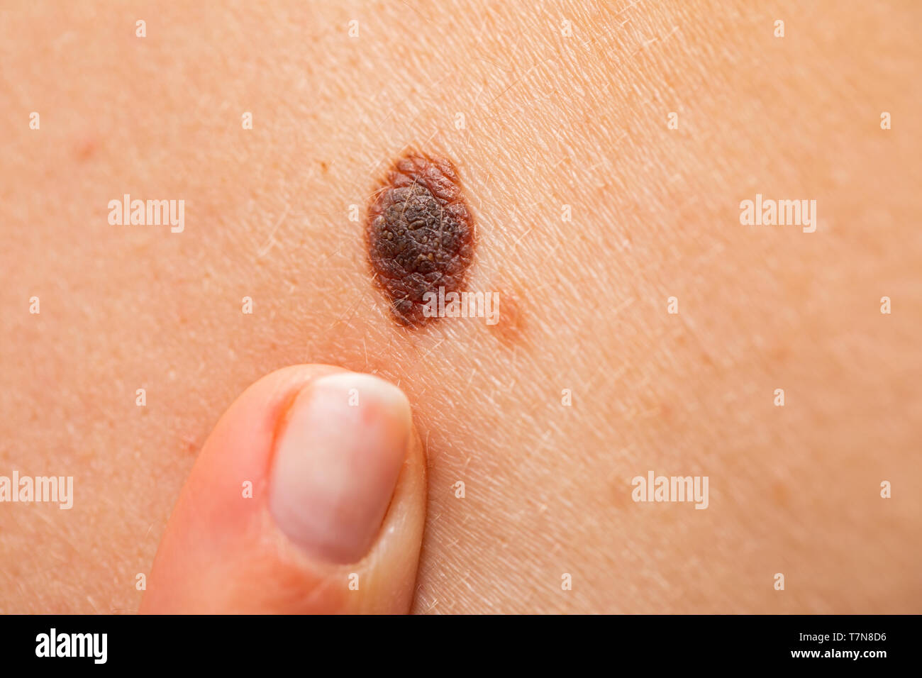Melanocytic nevus Banque de photographies et d’images à haute résolution - Alamy