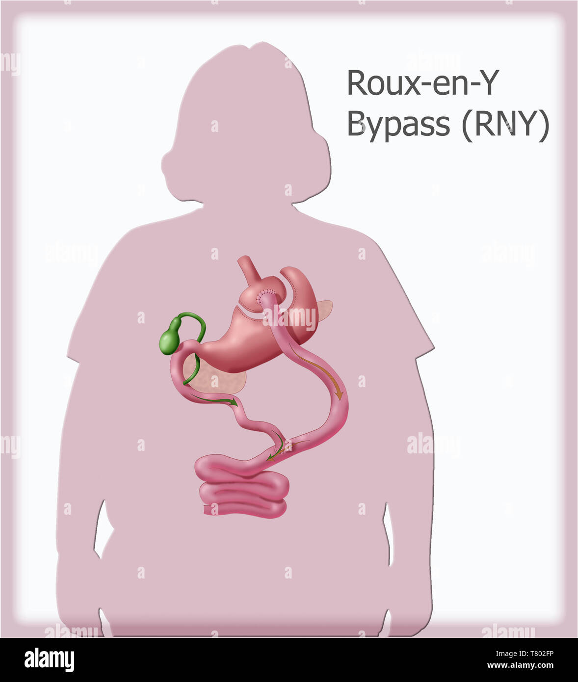 Roux En Y Gastric Bypass Surgery Photo Stock Alamy