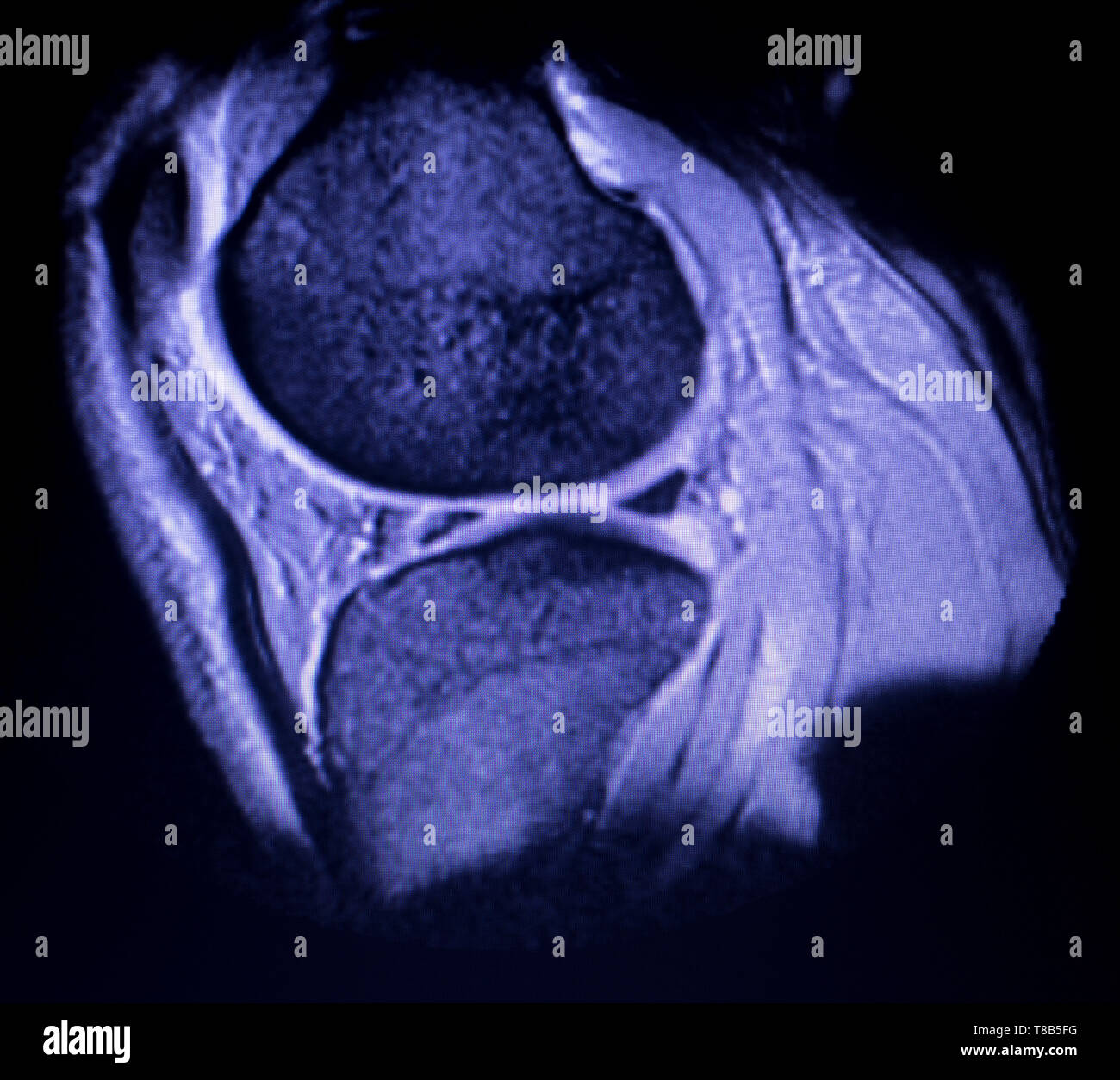 L'imagerie par résonance magnétique IRM GENOU corne postérieure du ...