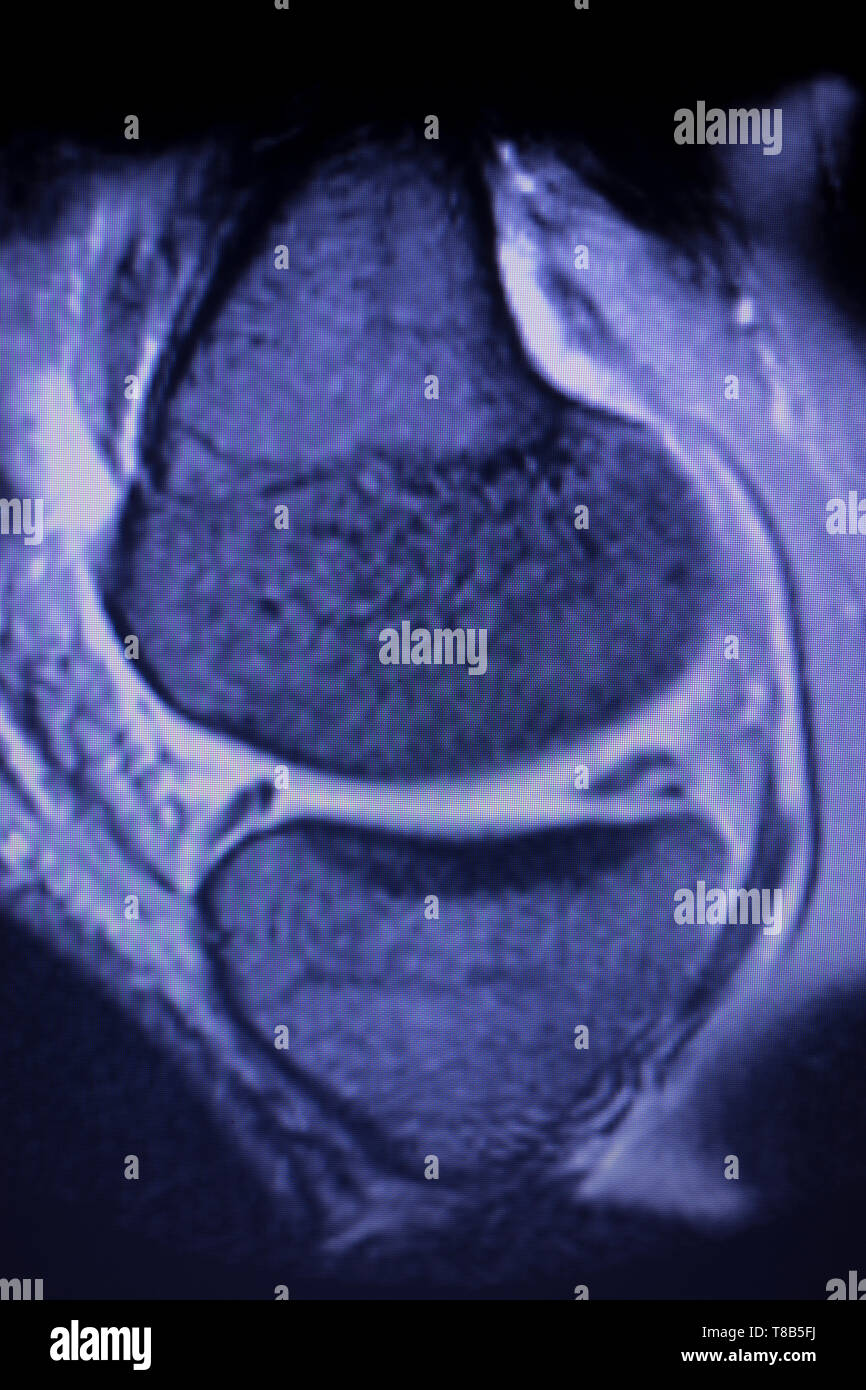 L'imagerie par résonance magnétique IRM GENOU corne postérieure du ...