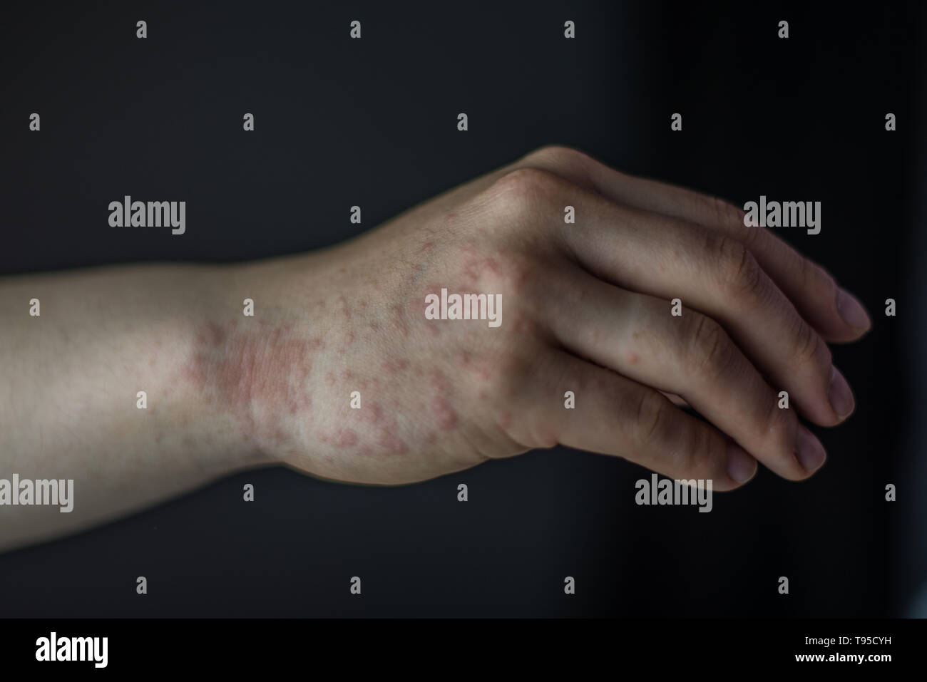 Maladie du zona Banque de photographies et d’images à haute résolution ...