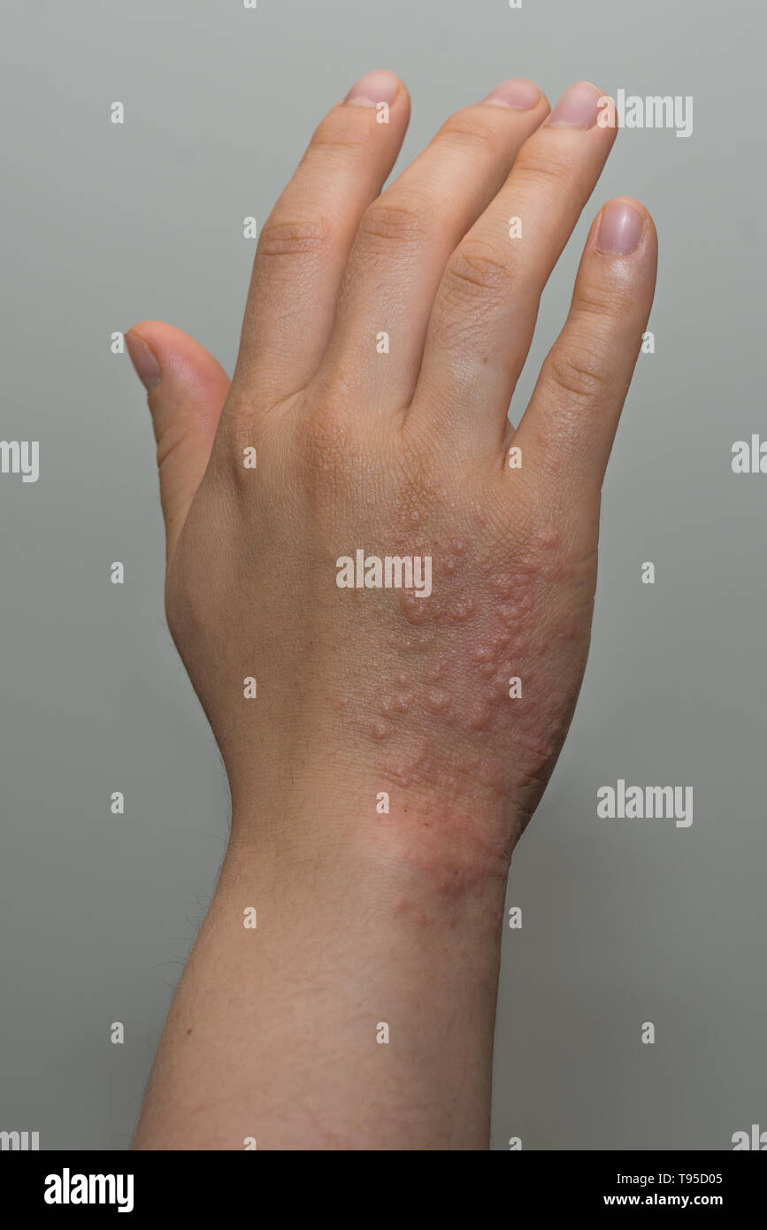 Maladie du zona Banque de photographies et d’images à haute résolution ...