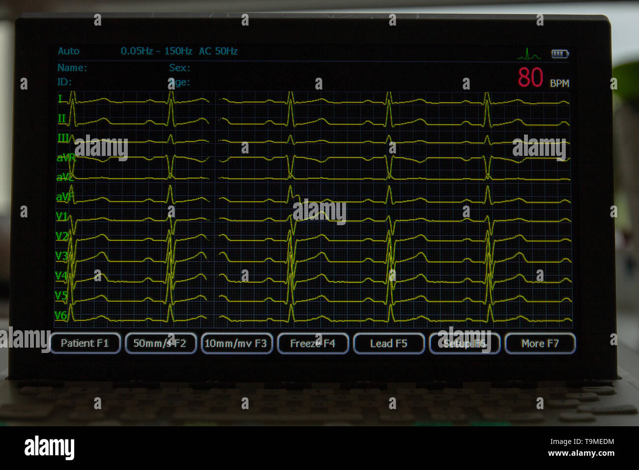 Diagrama de ekg Banque de photographies et d’images à haute résolution ...