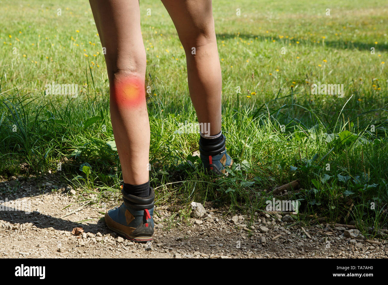 Maladie de la jambe rouge Banque de photographies et d’images à haute ...