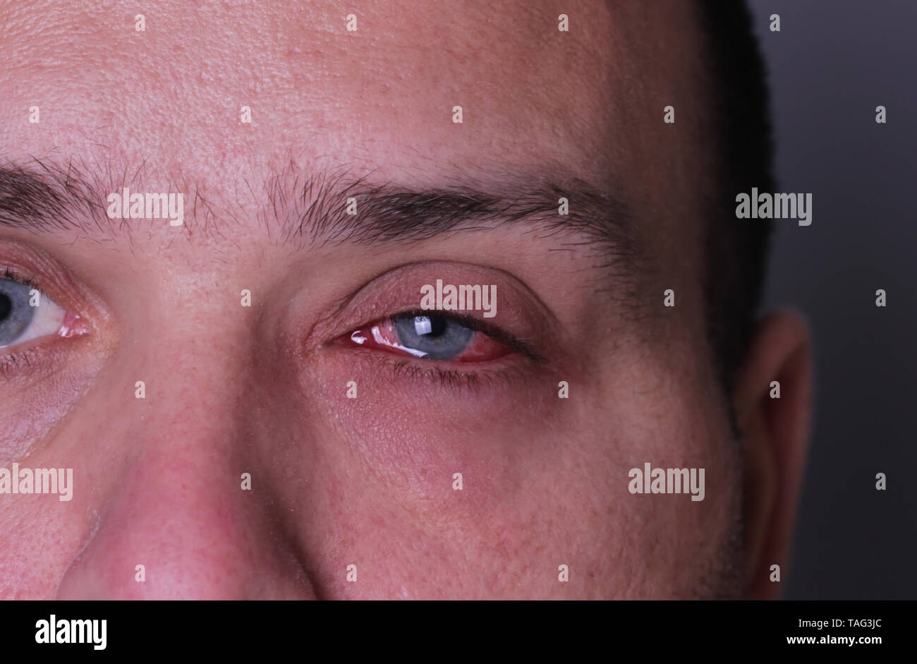 Conjonctivite virale Banque de photographies et d’images à haute ...