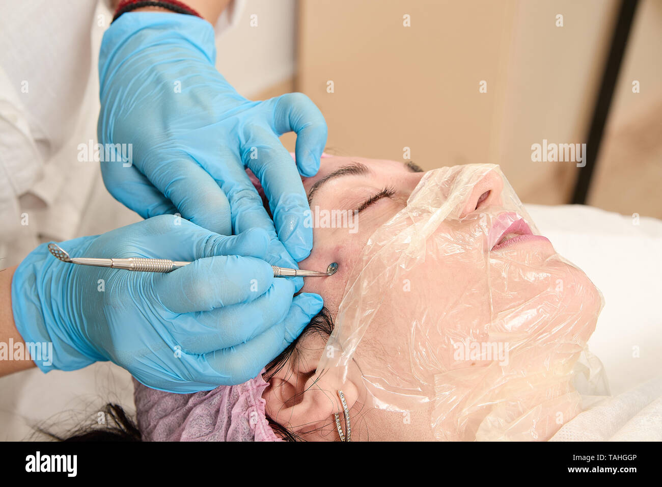 Facial pustule Banque de photographies et d’images à haute résolution ...