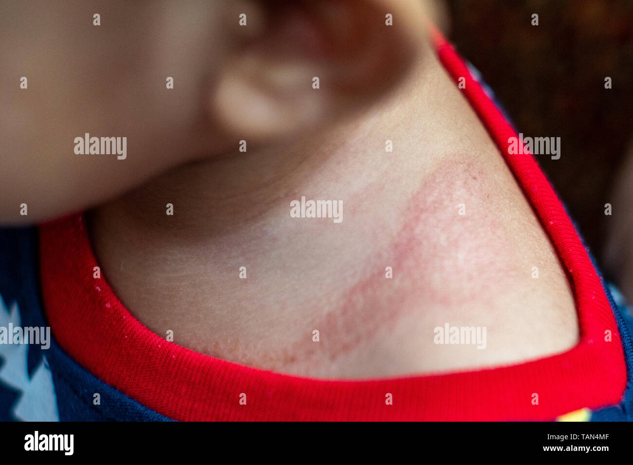 Tache rouge peau Banque de photographies et d’images à haute résolution ...