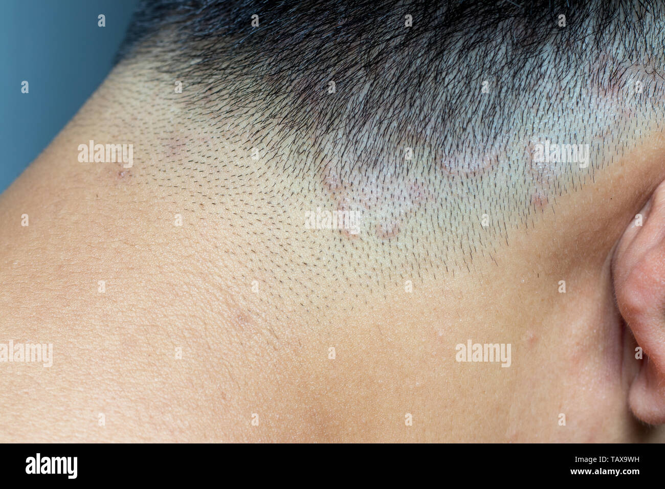 Fermé de la Teigne (tinea) sur la tête de l'homme asiatique (dermatite ...