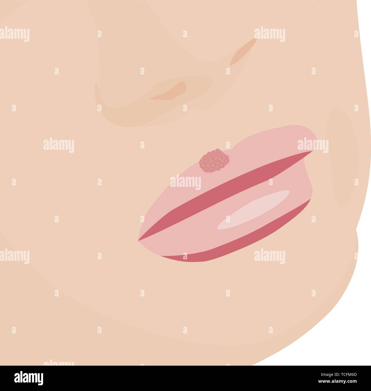 Cloques sur la peau Banque d'images vectorielles - Alamy