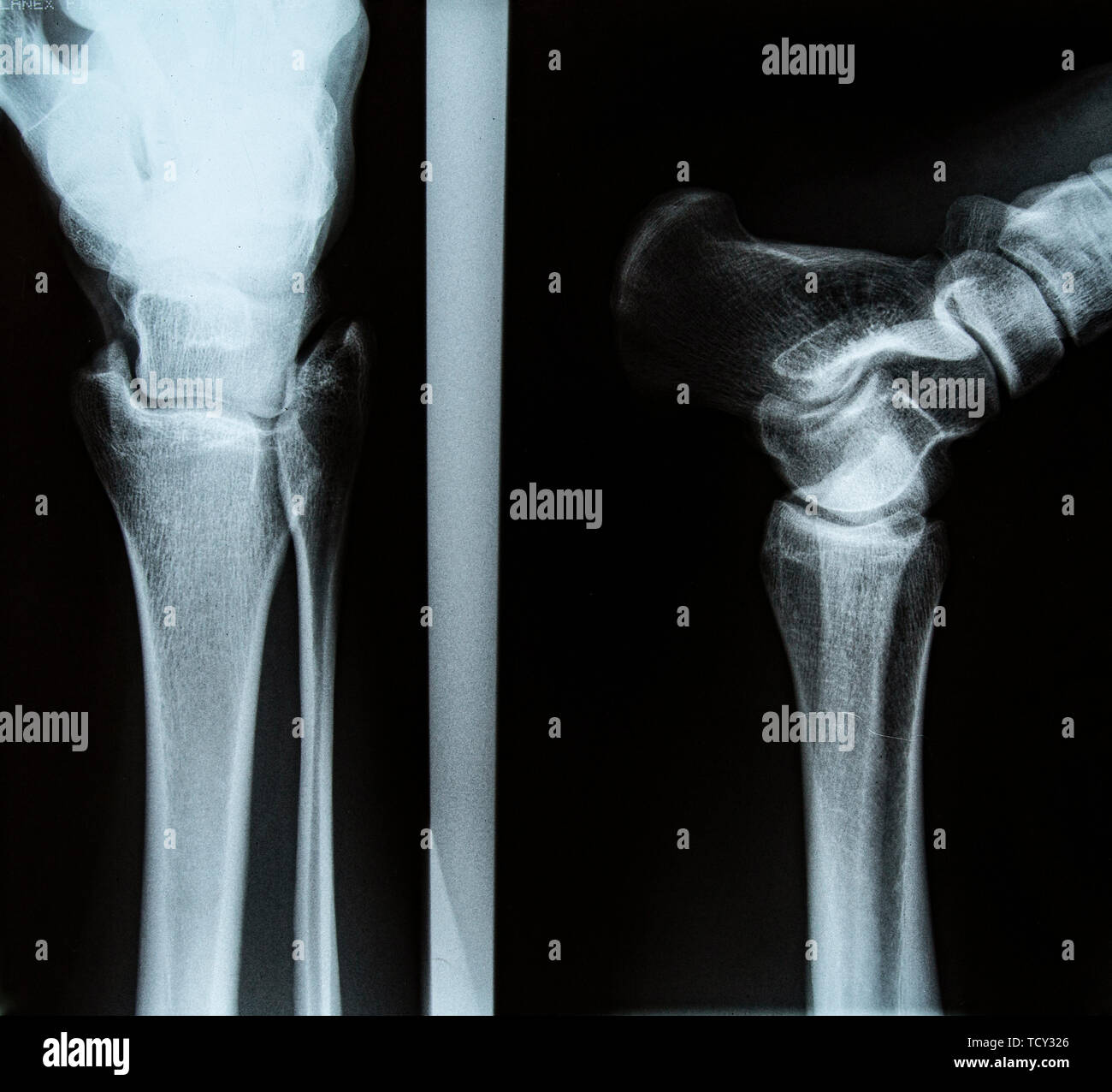 Radiographie d'une articulation du genou Photo Stock - Alamy