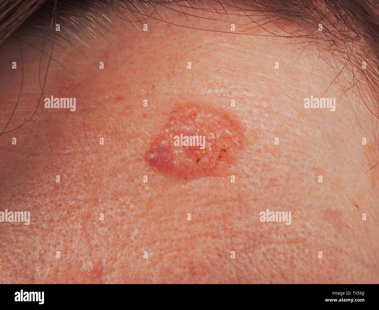 Basal cell carcinoma bcc Banque de photographies et d’images à haute ...
