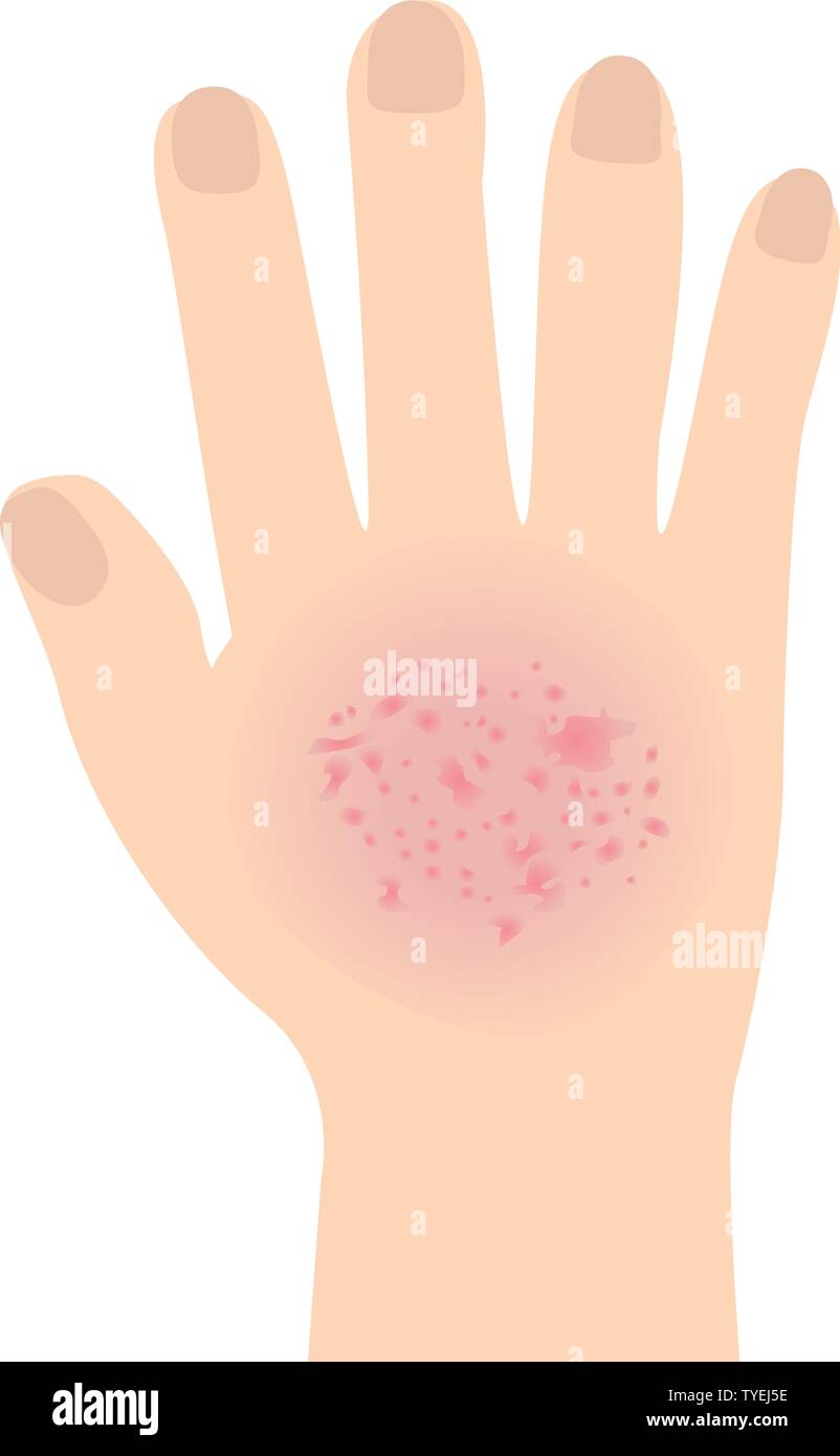 Maladie dermatologique Banque d'images vectorielles - Alamy