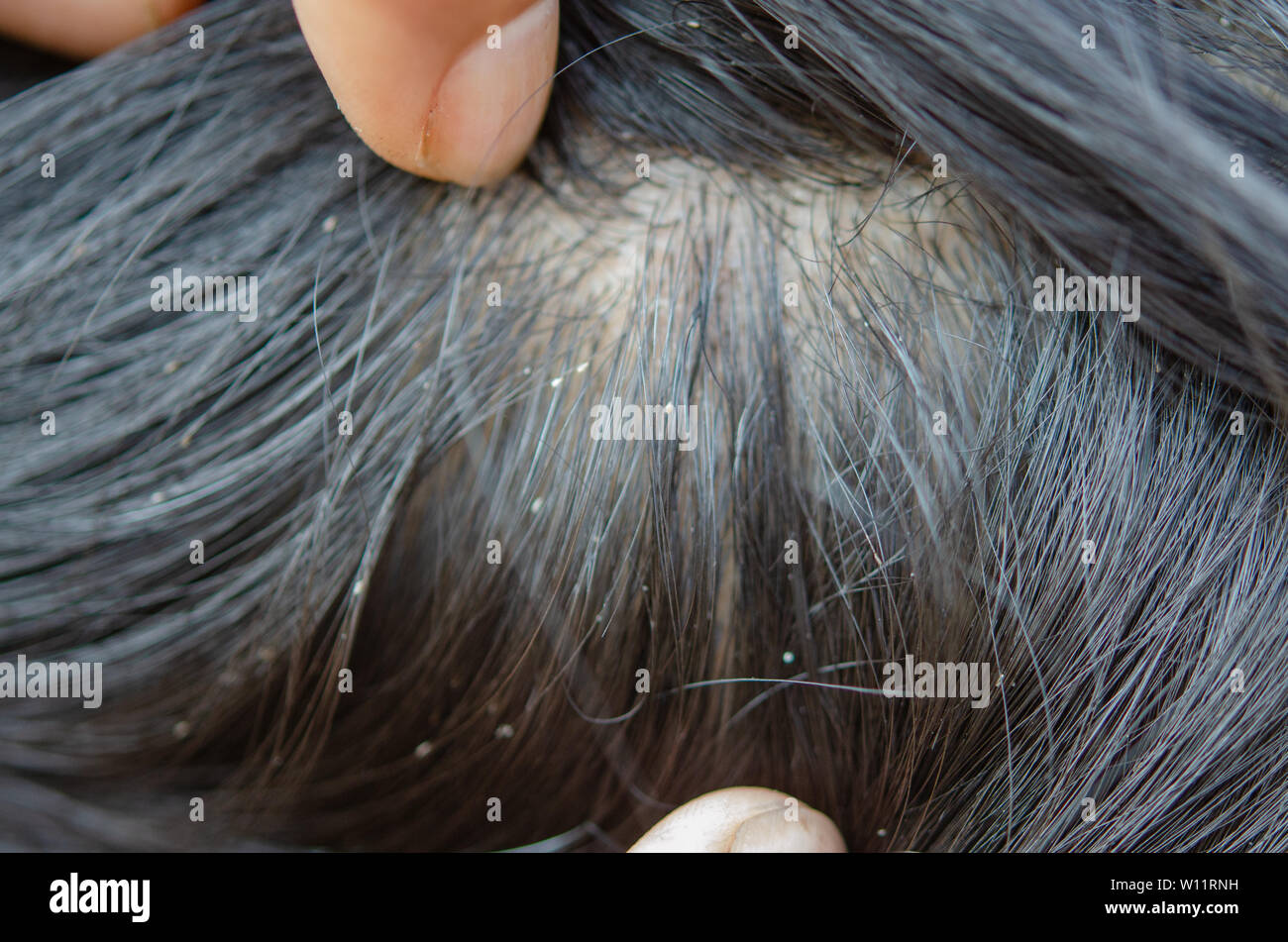 Oeufs de poux sur la tête de cheveux causes de démangeaisons Photo ...