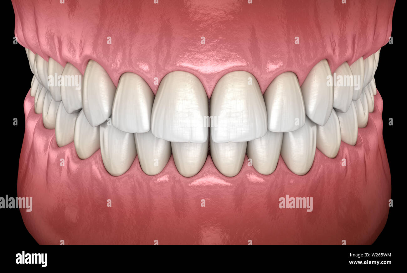 Les dents de la santé humaine avec occlusion normale vue frontale. Dent ...