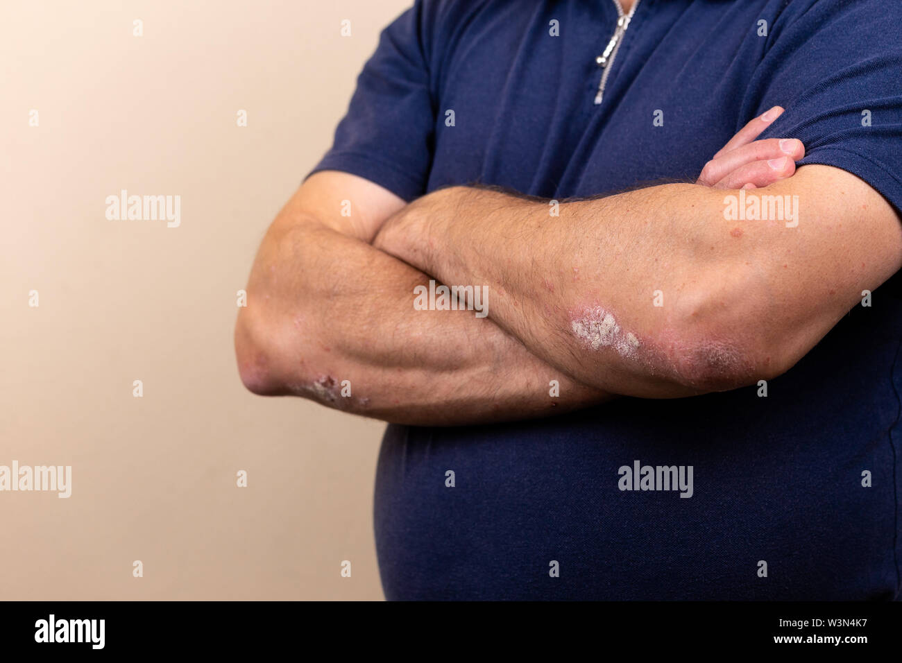 Gros plan sur la peau, une dermatite allergique Dermatite eczéma ...