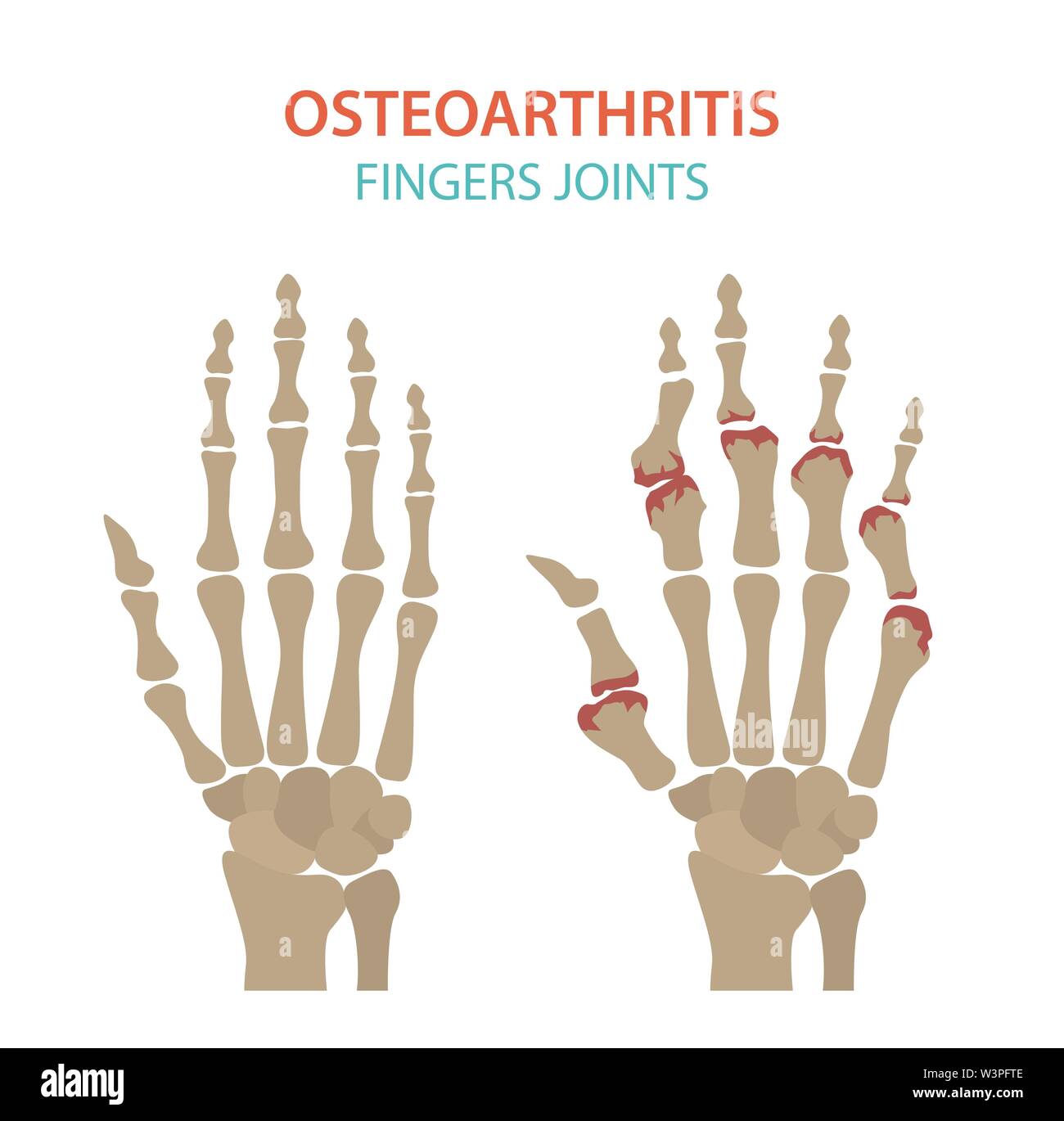 L'arthrite, l'arthrose Medical Design infographique. Le remplacement d ...