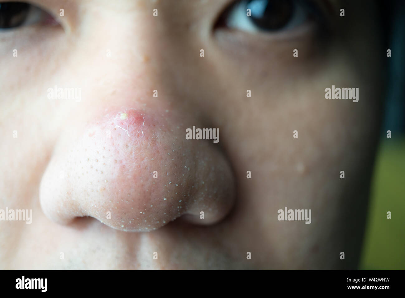 Texture de la peau sur le nez Banque de photographies et d’images à ...