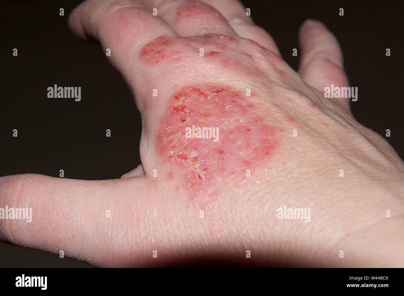 Hand with eczema Banque de photographies et d’images à haute résolution ...