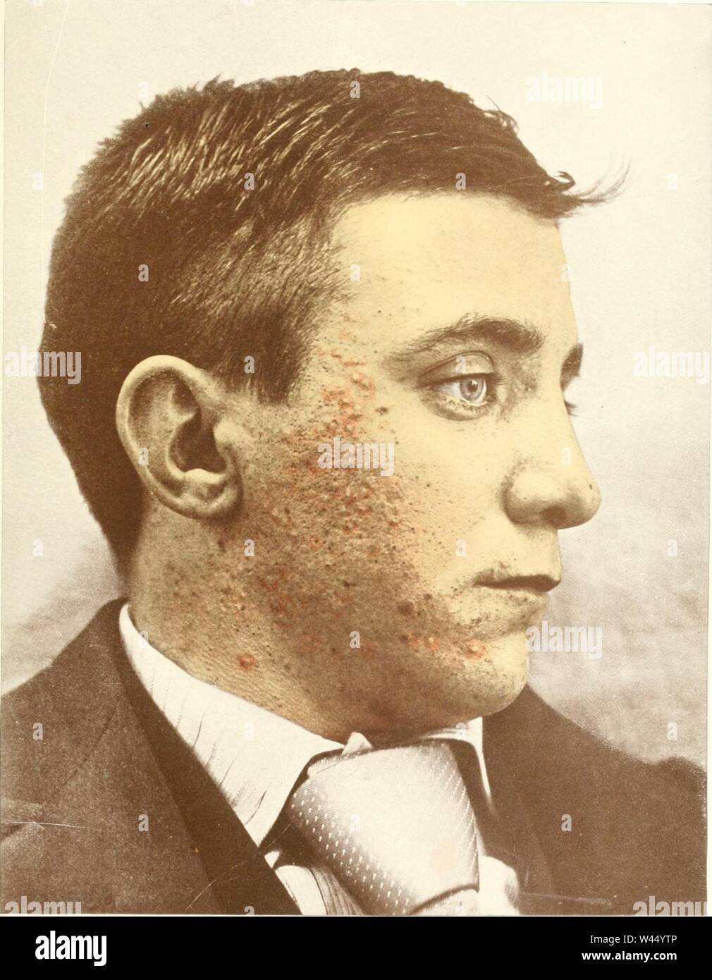 Comédon Banque de photographies et d’images à haute résolution - Alamy