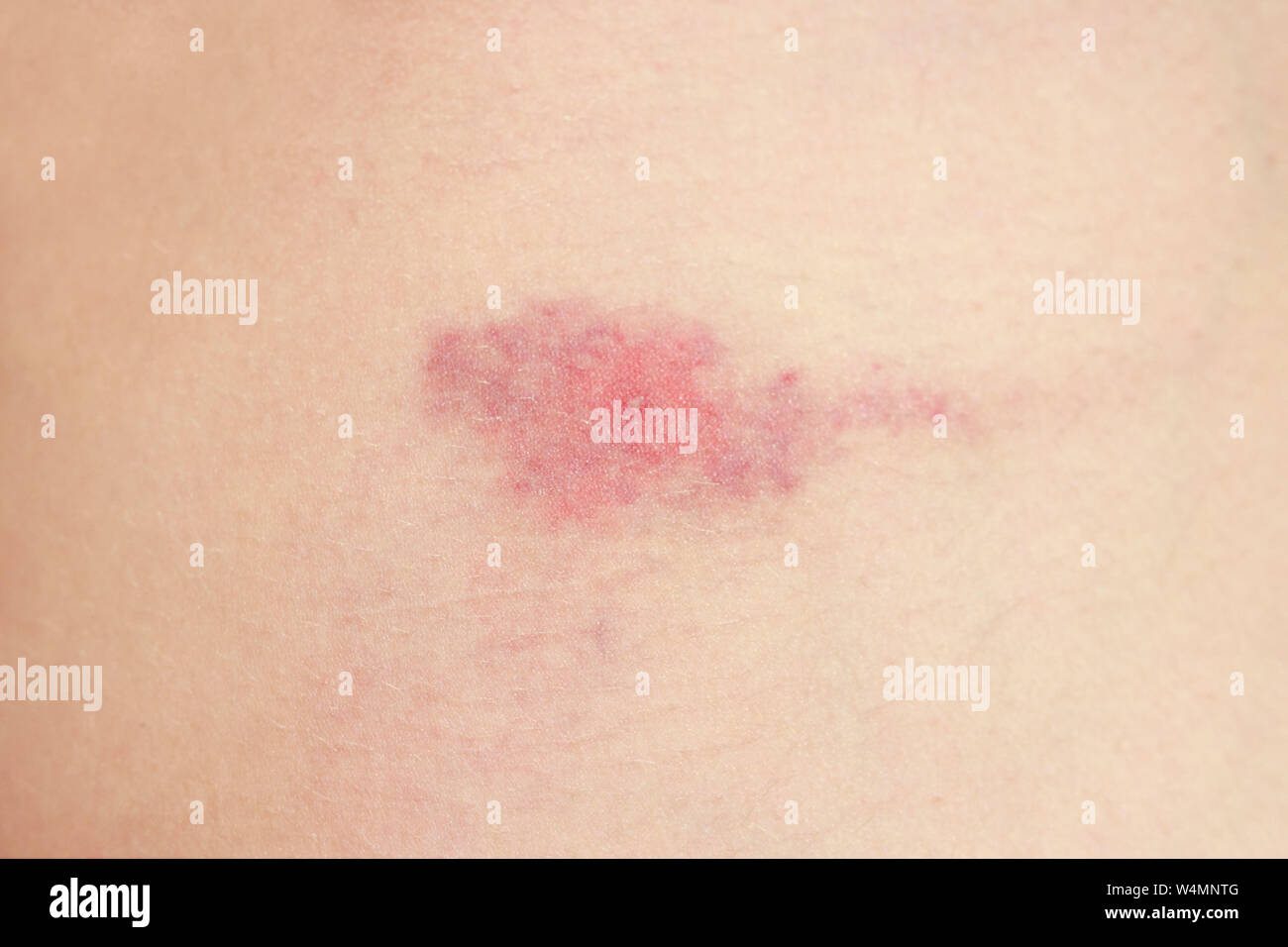 Midge piqûre de moustique. Réaction à la piqûre de moucherons de l ...