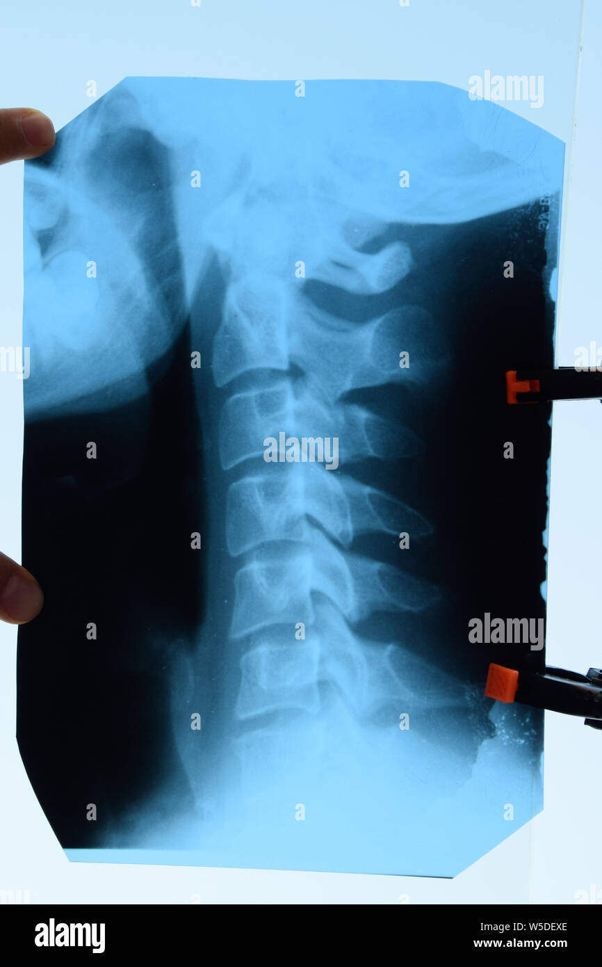 X-ray de la vertèbre cervicale. Radiographie de la colonne cervicale ...