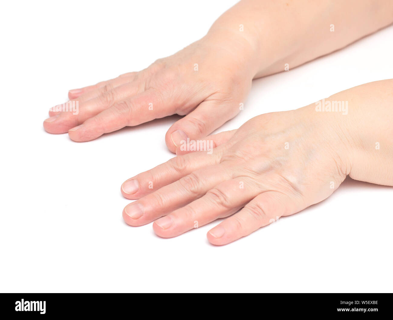 Rougeurs sur les mains Banque de photographies et d’images à haute ...