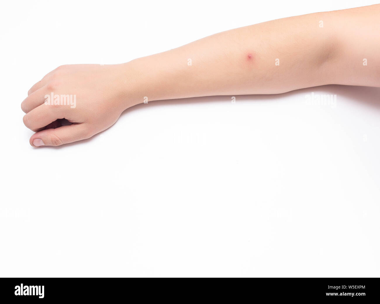 Tache rouge peau main Banque d'images détourées - Alamy
