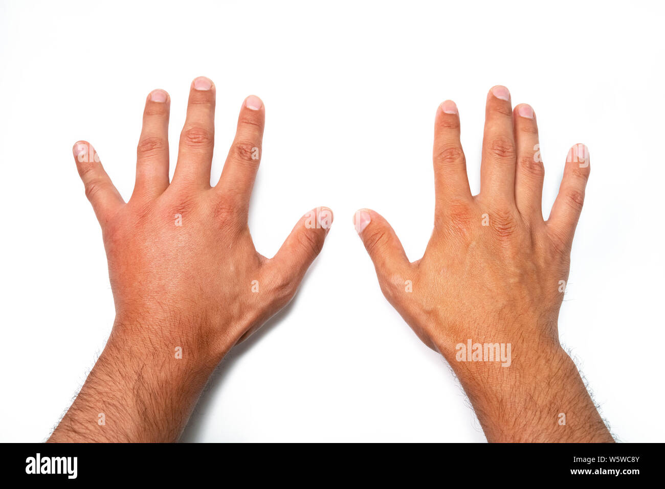 Piqûre d'insecte avec gonflement Banque d'images détourées - Alamy