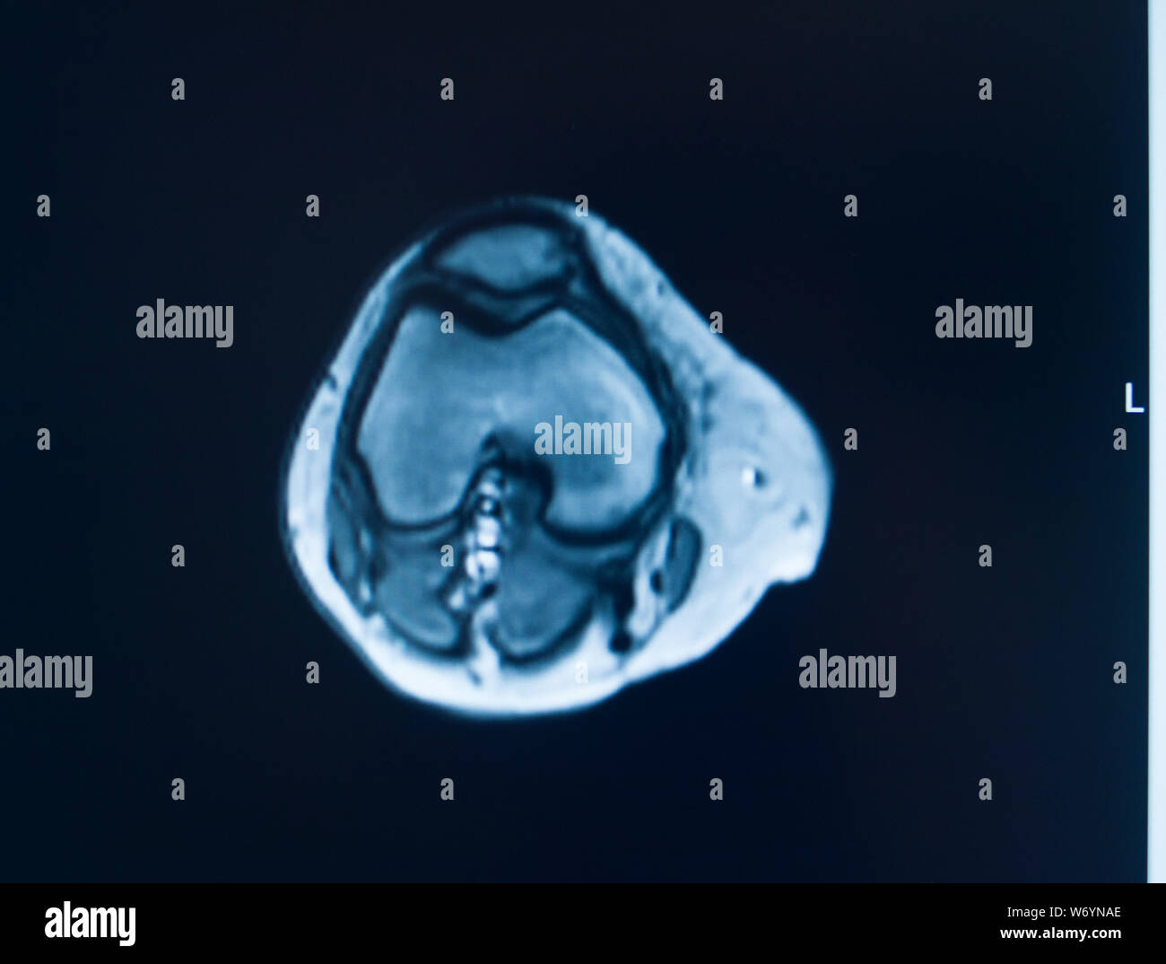 Blessures sportives du genou de grade 2 mcl IRM imagerie par résonance ...