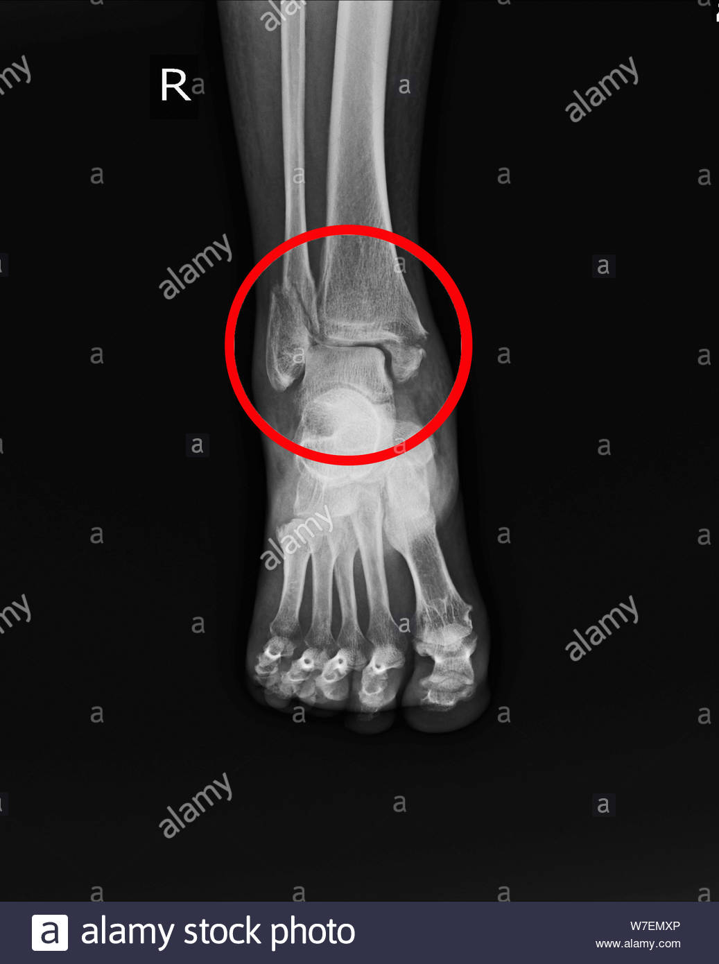 Distal Fibula Fracture Photos & Distal Fibula Fracture Images - Alamy