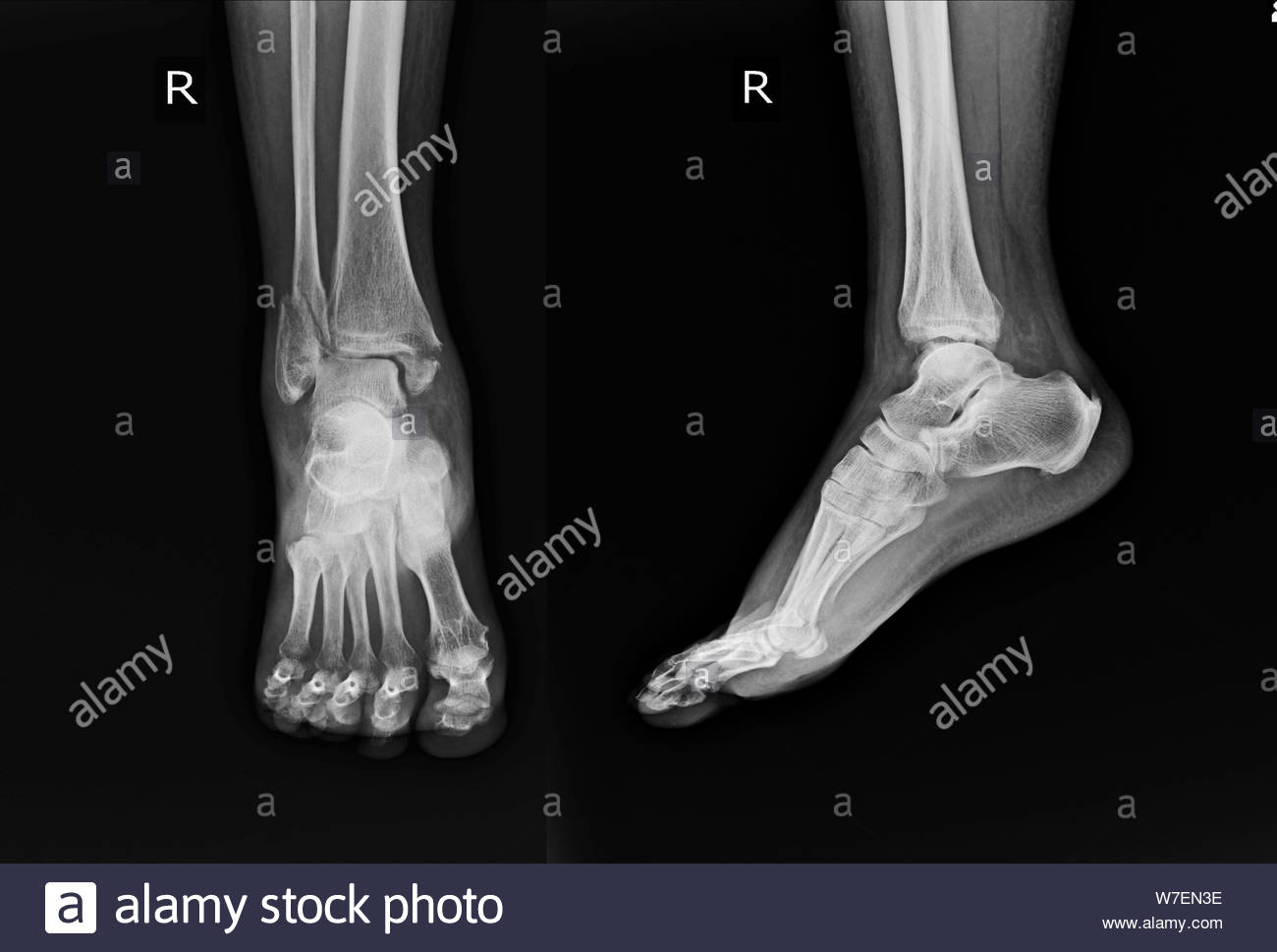 Distal Fibula Fracture Photos & Distal Fibula Fracture Images - Alamy