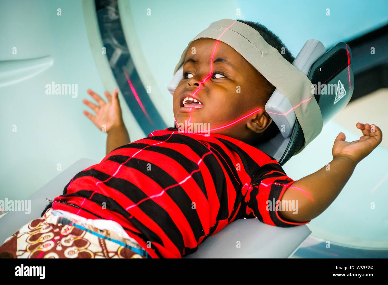 Fille (3 ans) qui souffre d'hydrocéphalie (spina bifida) dans un CT ...