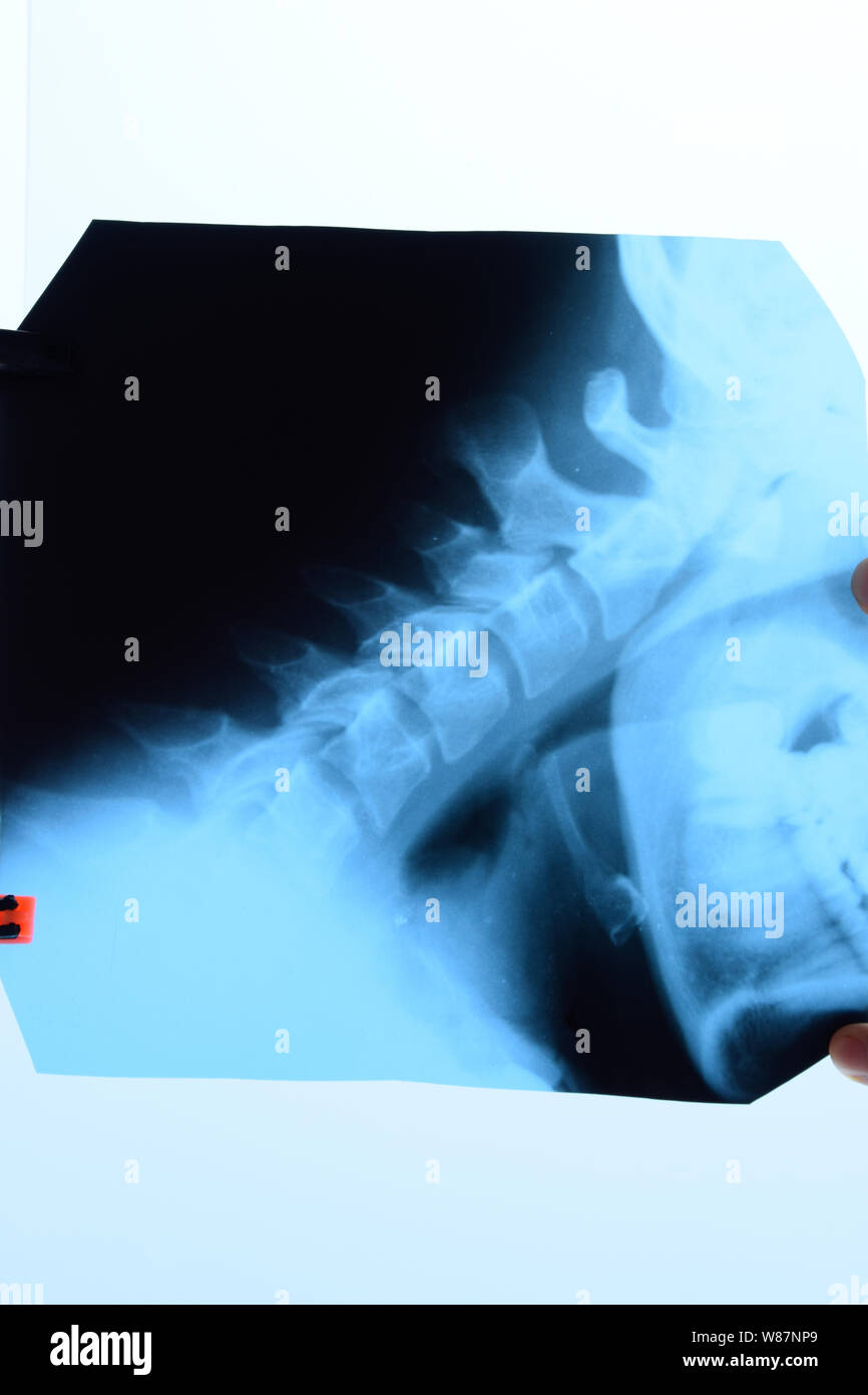 Discopathie cervicale Banque d'image et photos - Page 2 - Alamy