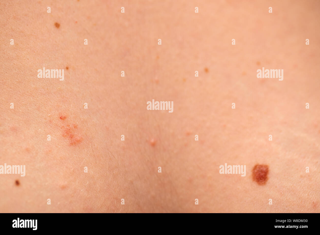 Mélanome malin nodulaire Banque de photographies et d’images à haute résolution - Alamy