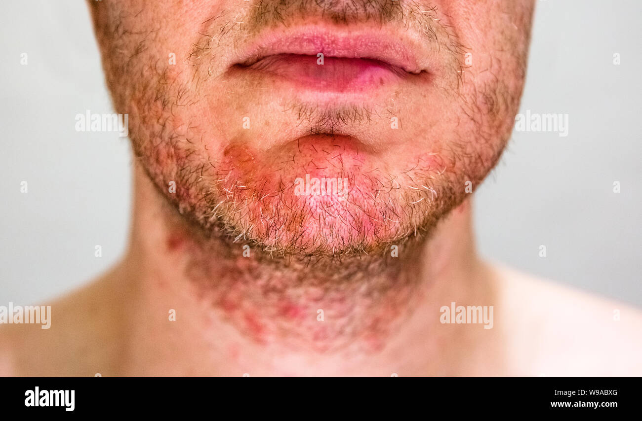 L'homme avec la dermatite séborrhéique dans la région de beard Photo ...