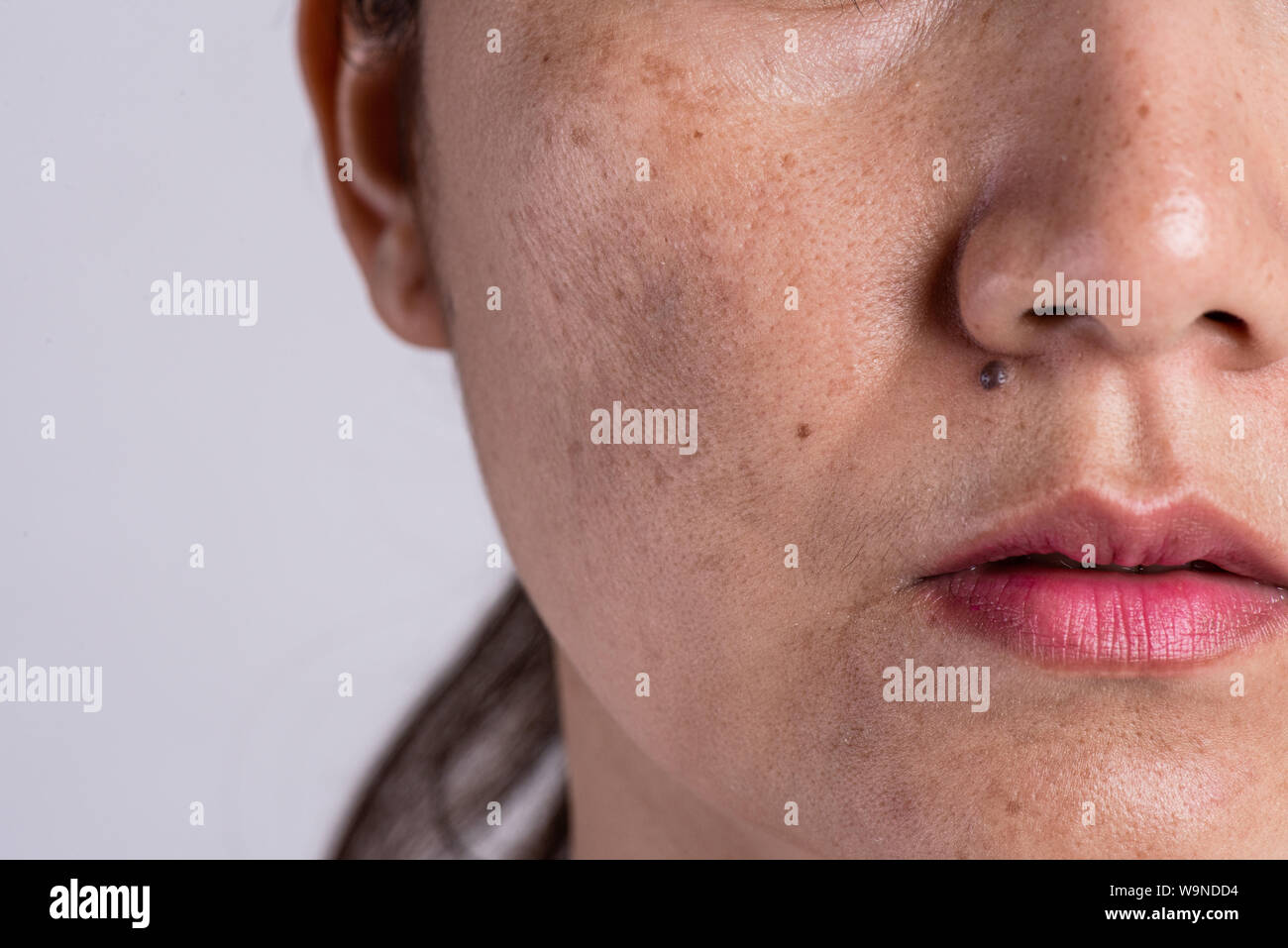 Pigmentation Taches Peau Banque d'image et photos - Alamy
