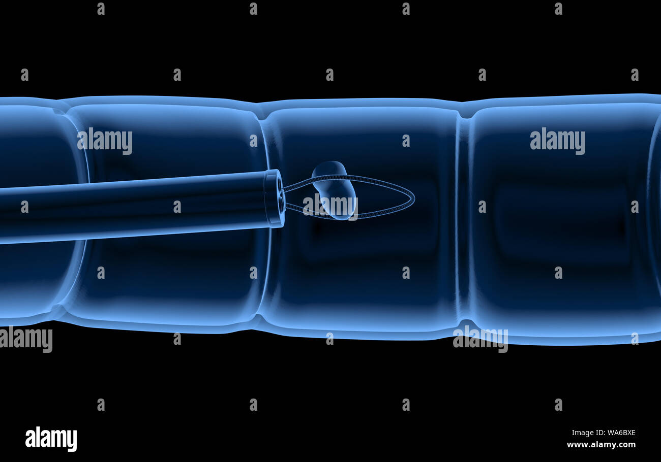 Le rendu 3d x-ray retirer l'endoscope polype colique avec boucle de fil ...