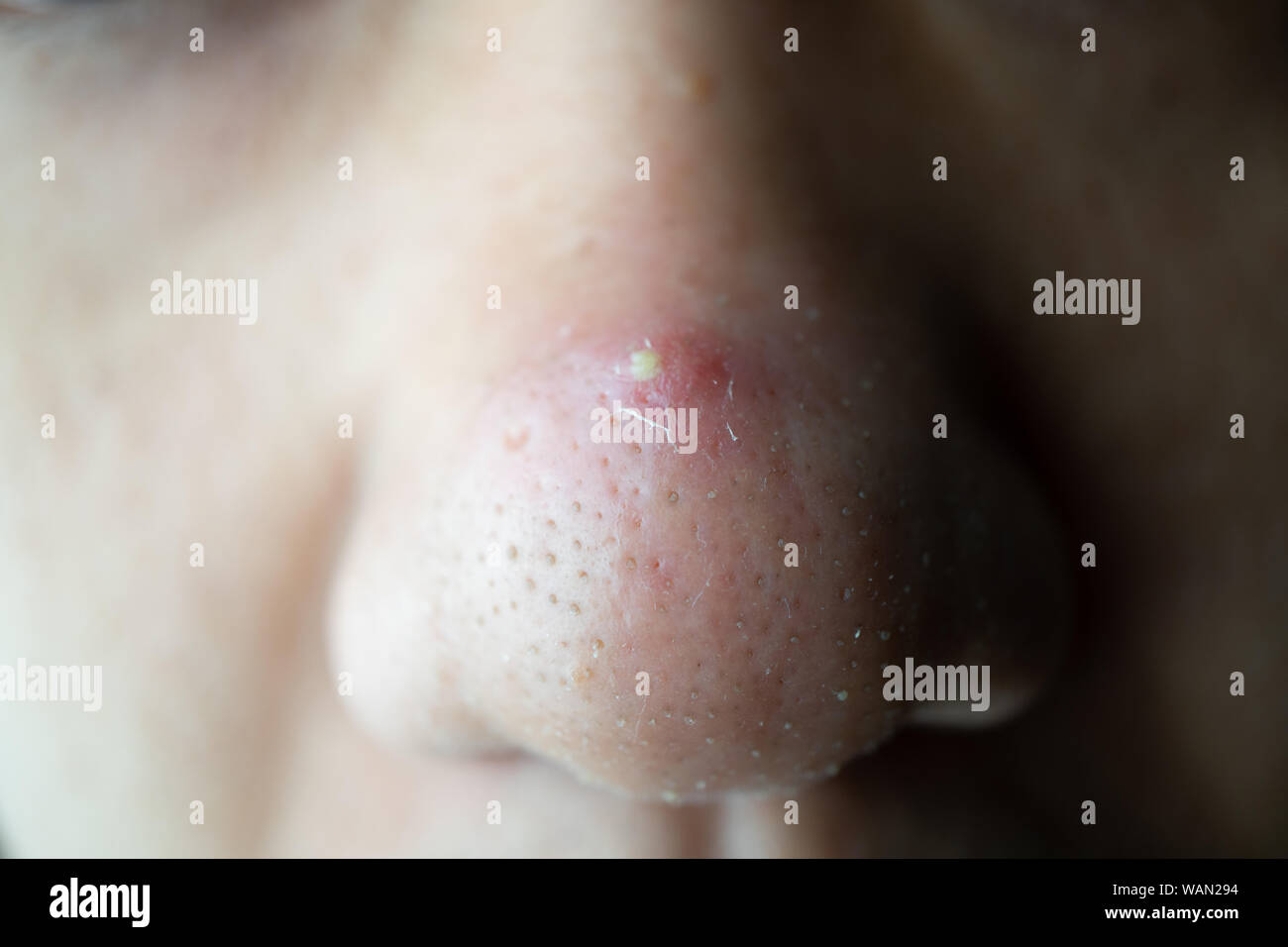 Acne scars Banque de photographies et d’images à haute résolution - Alamy