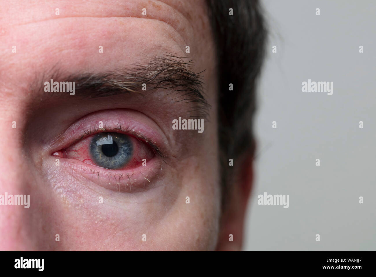 Conjonctivite Allergique Banque d'image et photos - Alamy