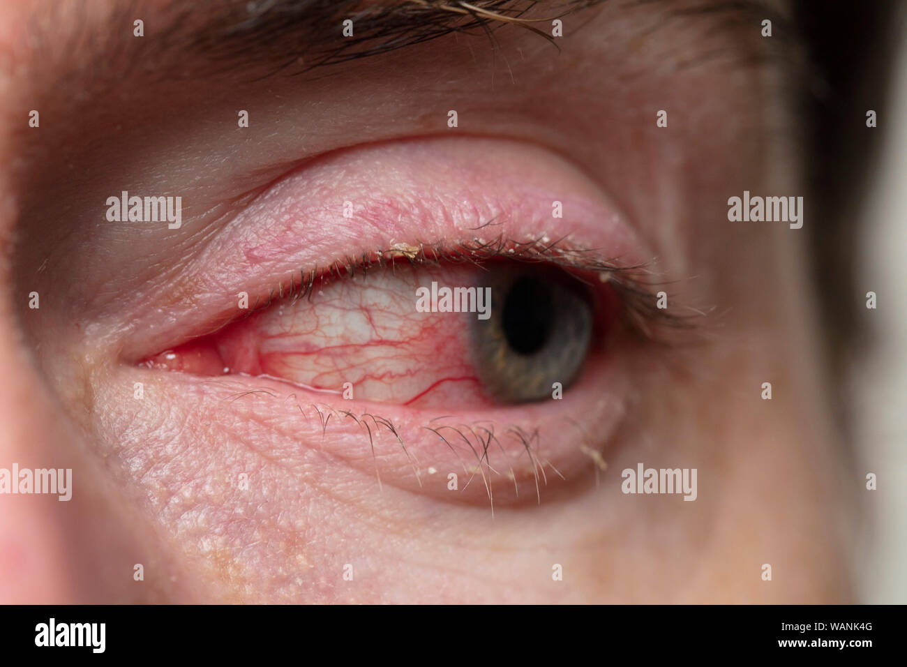 Rougeur oculaire Banque de photographies et d’images à haute résolution ...