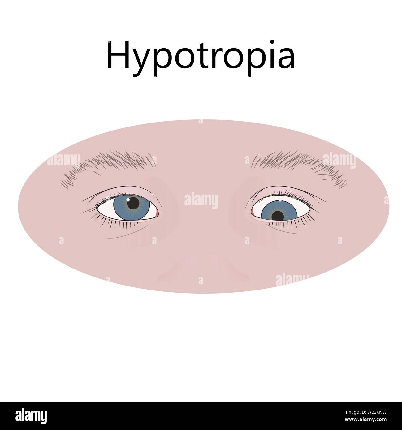 Strabismus eye Banque de photographies et d’images à haute résolution ...