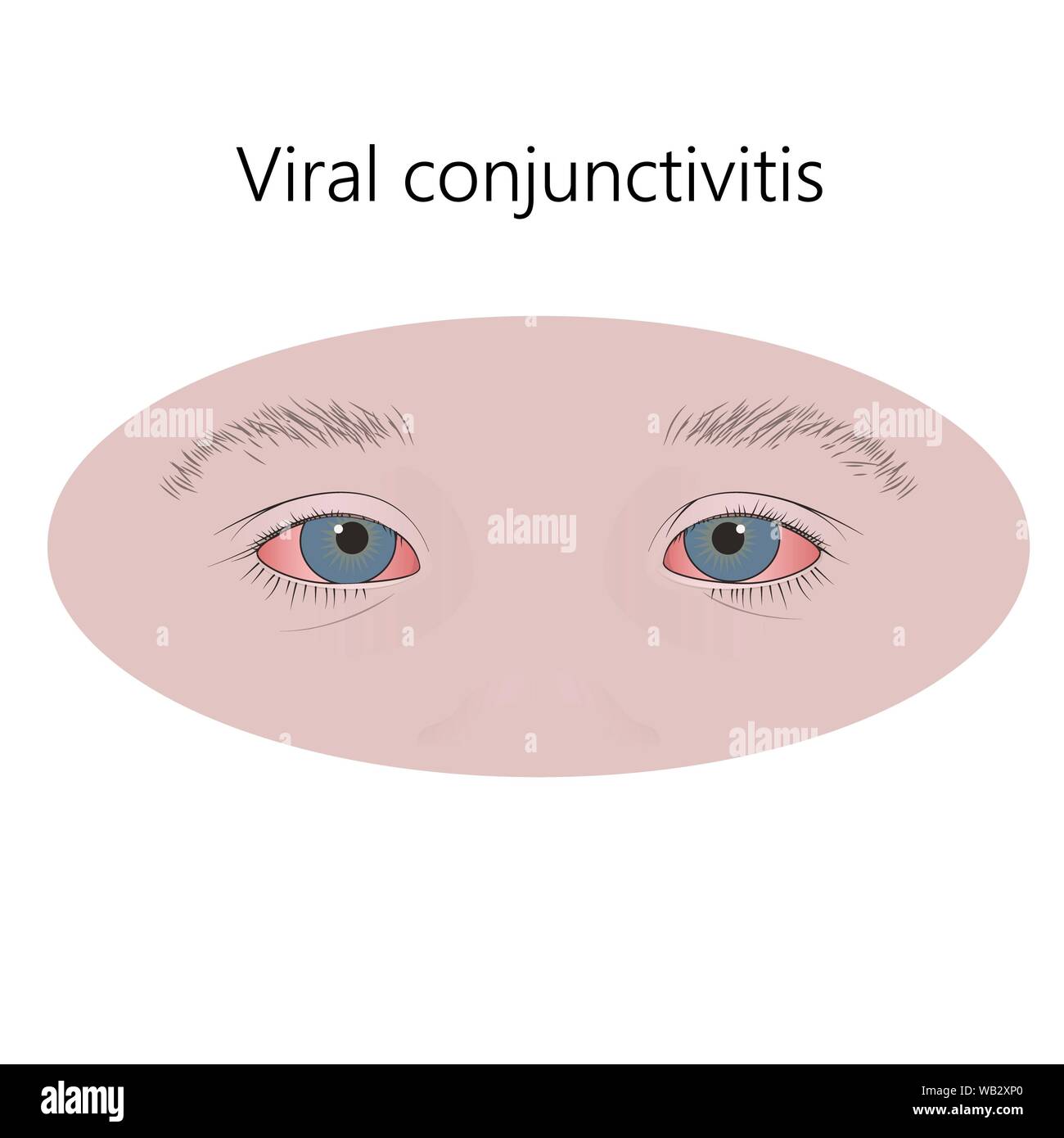 Veines De Conjonctivite Banque d'image et photos - Alamy